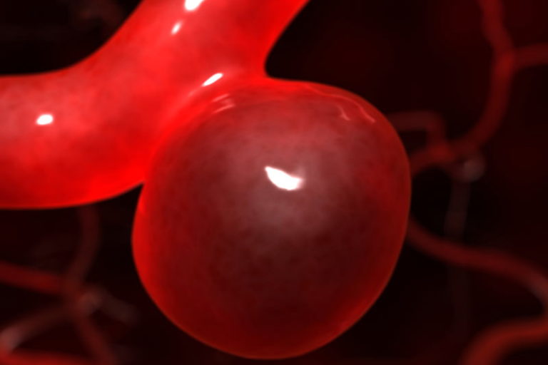 Aneurysma: Ursachen, Symptome und Therapie - eMEDI.de