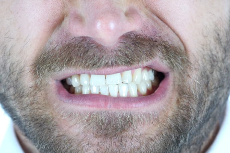 Bruxismus: Ursachen, Symptome und Therapie | eMEDI