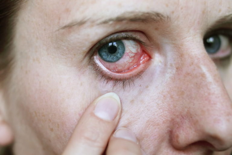 Rote Augen: Ursachen, Therapie und Behandlung | eMEDI